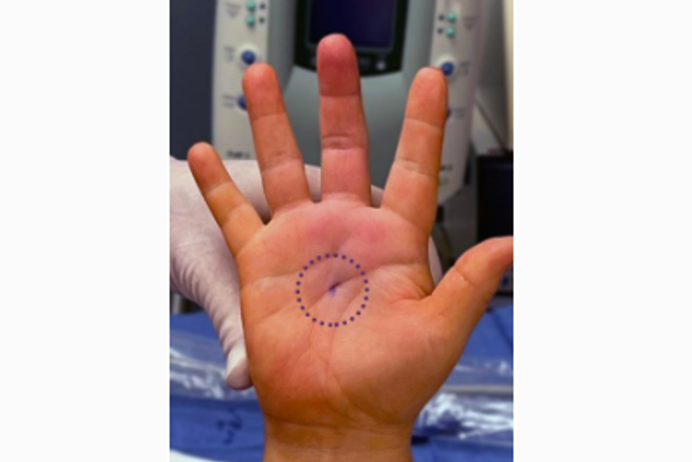 Trigger Finger Thumb Test at Walter Graves blog