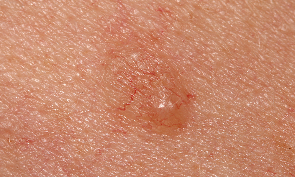 Basal Cell Carcinoma BCC For Cumming Dawsonville Dahlonega Toccoa Basal Cell Carcinoma BCC For Cumming Dawsonville Dahlonega Toccoa