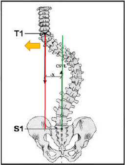Adult Scoliosis Treatment - Nanuet, NY: : Hudson Valley Scoliosis ...