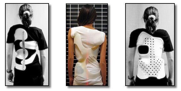 Advanced Scoliosis Brace Nanuet Ny Hudson Valley Scoliosis