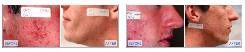 Acne Before and After Gallery - Dover, OH & Canton, OH: Ohio Laser ...