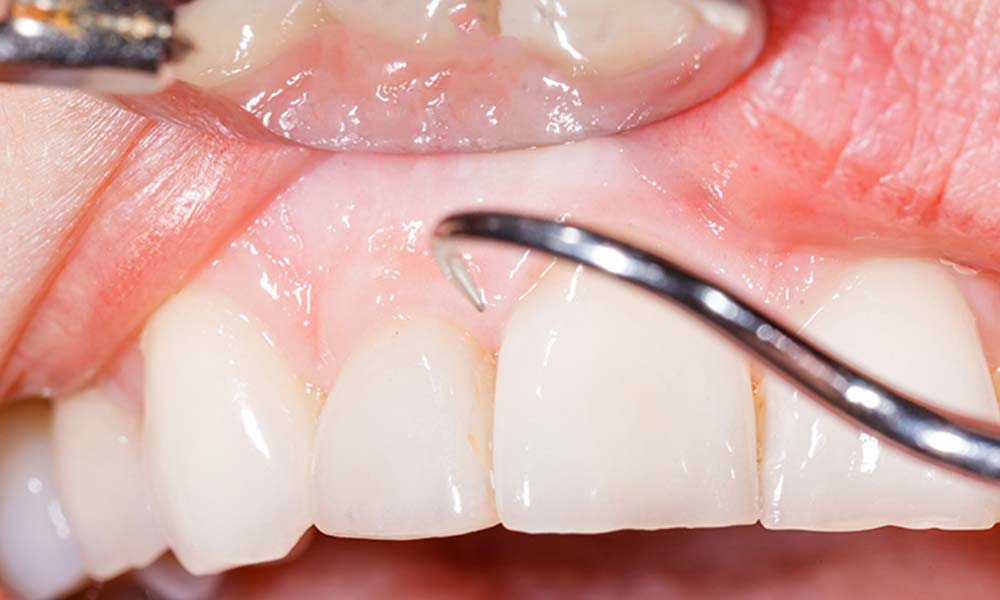 Recurring Swollen Gums? Here's What to Do: Cascadia Dental Specialists ...